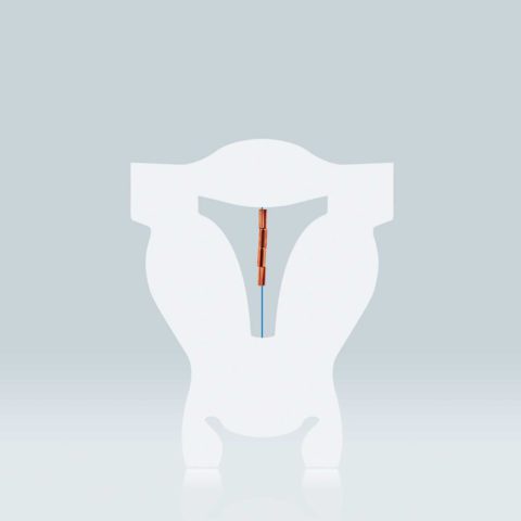 Gynefix-Verhütungskette | Dr. med. Dirk Alter